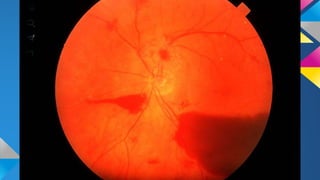 Fundoscopy Pictures | PPTX