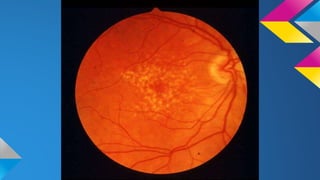 Fundoscopy Pictures | PPTX
