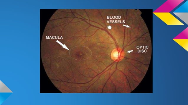 Fundoscopy Pictures | PPTX | Eye and Vision Conditions | Diseases and ...