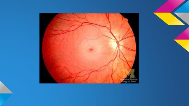 Fundoscopy Pictures | PPTX | Eye and Vision Conditions | Diseases and ...