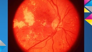 Fundoscopy Pictures | PPT