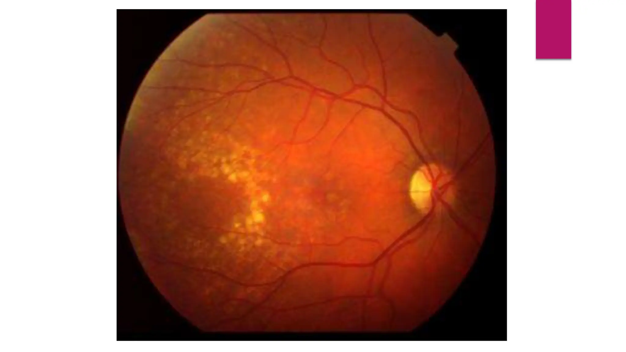 Fundoscopy images-1.pptx