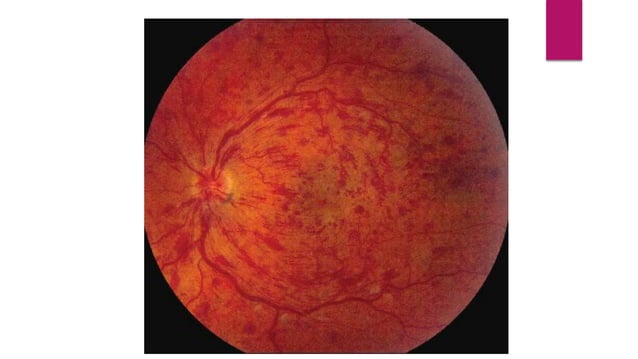 Fundoscopy images-1.pptx | Eye and Vision Conditions | Diseases and ...