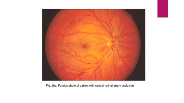 Fundoscopy images-1.pptx | Eye and Vision Conditions | Diseases and ...