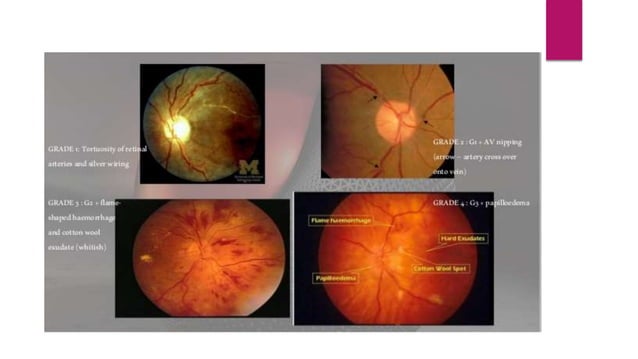 Fundoscopy images-1.pptx | Eye and Vision Conditions | Diseases and ...