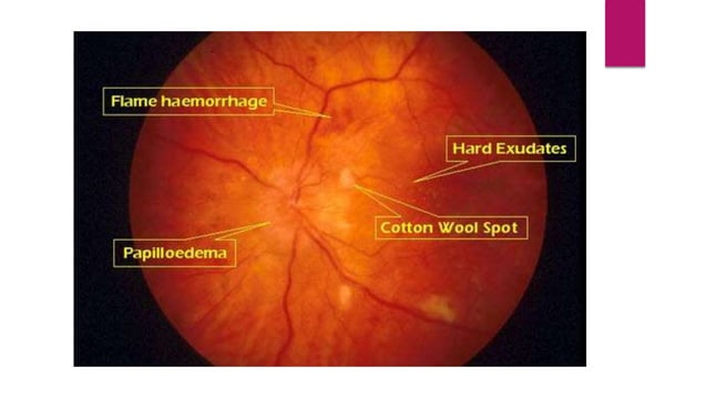Fundoscopy images-1.pptx | Eye and Vision Conditions | Diseases and ...