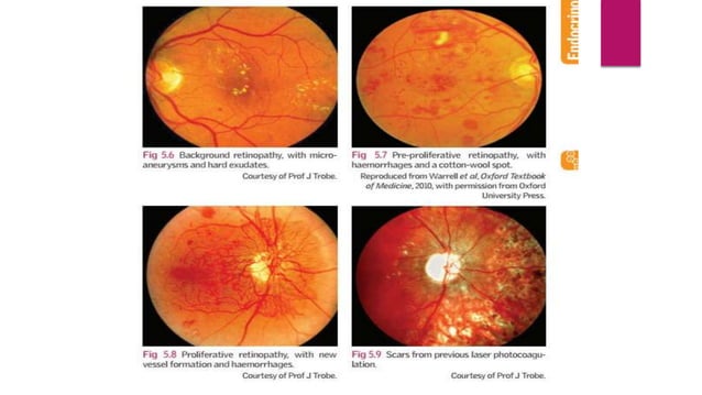 Fundoscopy images-1.pptx | Eye and Vision Conditions | Diseases and ...