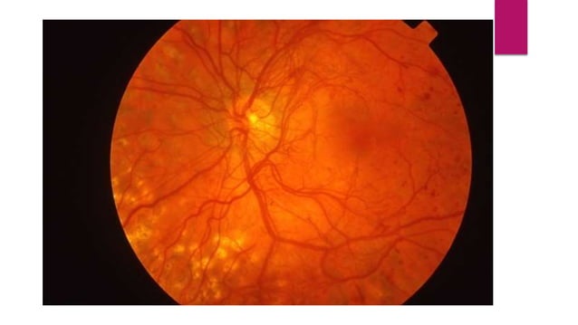 Fundoscopy images-1.pptx | Eye and Vision Conditions | Diseases and ...