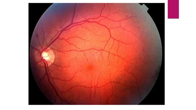 Fundoscopy images-1.pptx | Eye and Vision Conditions | Diseases and ...