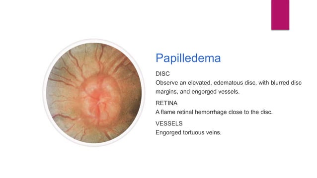 Fundoscopy images-1.pptx | Eye and Vision Conditions | Diseases and ...