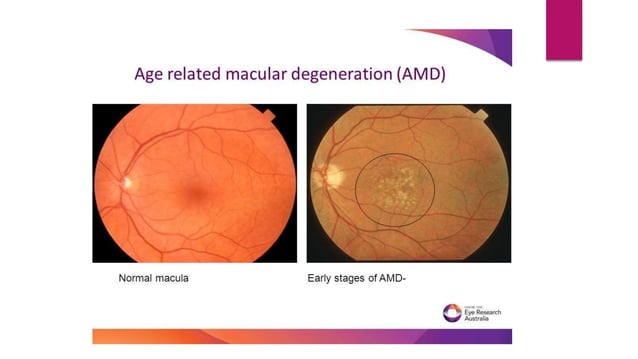 Fundoscopy images-1.pptx | Eye and Vision Conditions | Diseases and ...