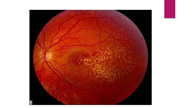 Fundoscopy images-1.pptx | Eye and Vision Conditions | Diseases and ...
