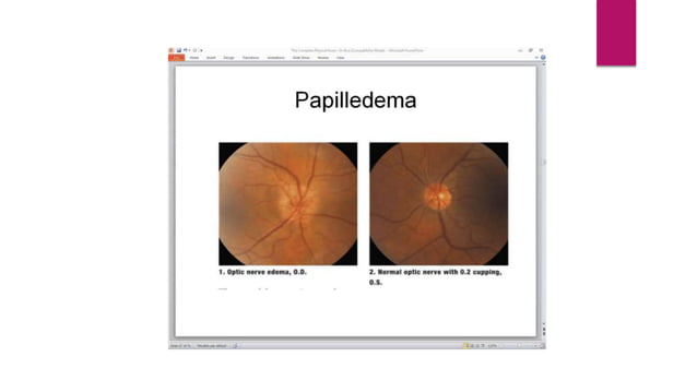 Fundoscopy images-1.pptx | Eye and Vision Conditions | Diseases and ...