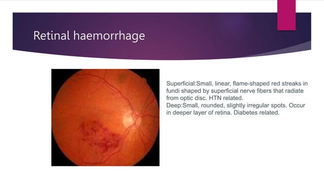 Fundoscopy images-1.pptx | Eye and Vision Conditions | Diseases and ...