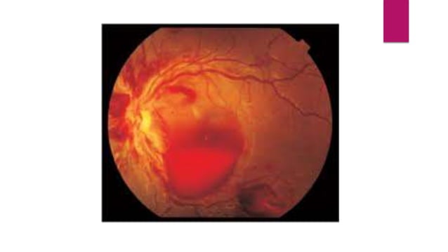 Fundoscopy images-1.pptx | Eye and Vision Conditions | Diseases and ...