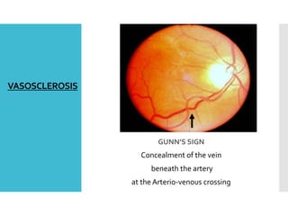 Fundoscopy in pih | PPT