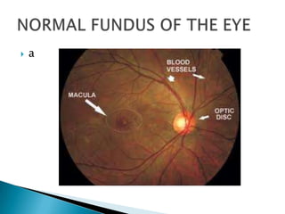 Fundoscopy ppt 2012 | PPTX