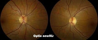 Fundus examination | PDF
