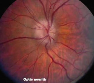 Fundus examination | PDF