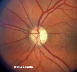 Fundus examination | PDF