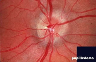 Fundus examination | PDF