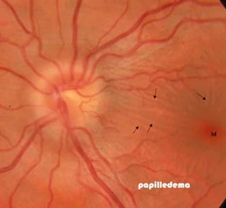 Fundus examination | PDF
