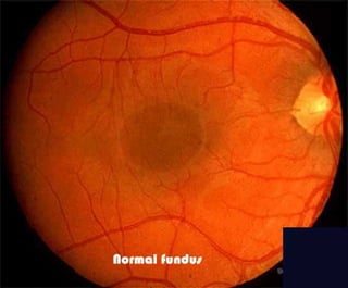 Fundus examination | PPT