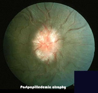 Fundus examination | PDF