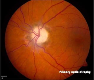 Fundus examination | PPT