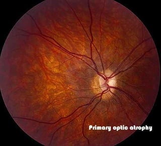 Fundus examination | PDF