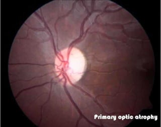 Fundus examination | PDF