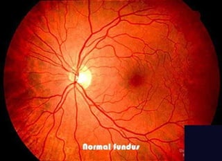 Fundus examination | PDF