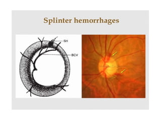 Fundus in Glaucoma | ODP