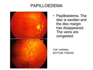 Papilledema Vs Normal Fundoscopy