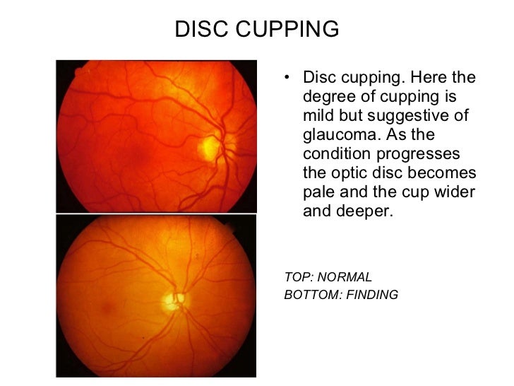 Optic Disc Normal Illustrations