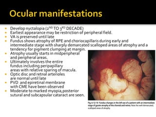 hereditary macular and choroidal dystrophies | PDF | Eye and Vision ...