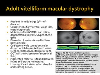 hereditary macular and choroidal dystrophies | PDF | Eye and Vision ...