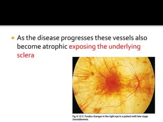 hereditary macular and choroidal dystrophies | PDF | Eye and Vision ...