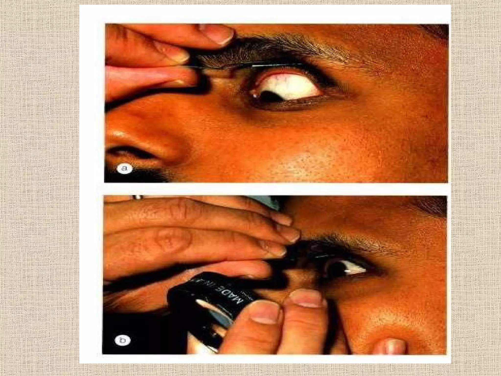 Fundus examination | PPT