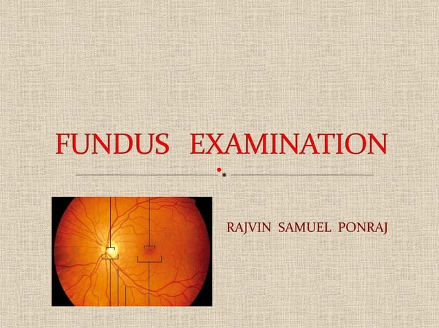Fundus examination | PPT | Eye and Vision Conditions | Diseases and ...