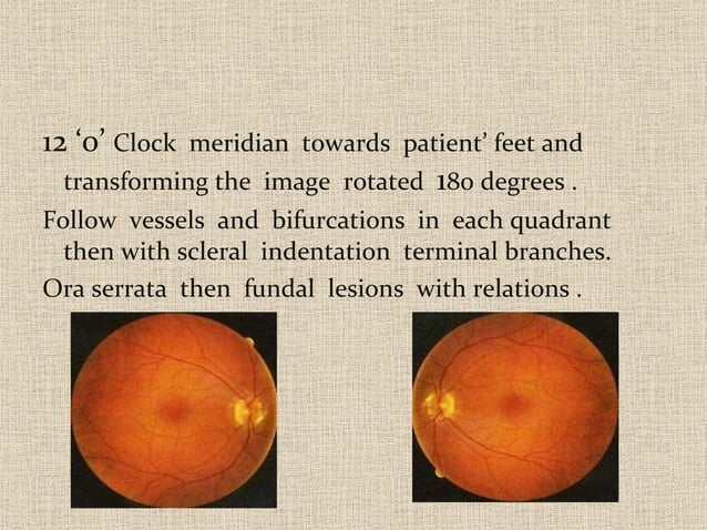 Fundus examination | PPT | Eye and Vision Conditions | Diseases and ...