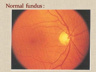 Fundus examination | PPT