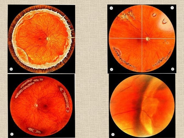Fundus examination | PPT | Eye and Vision Conditions | Diseases and ...