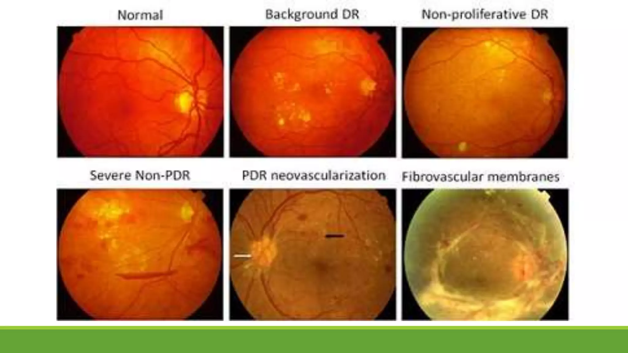 Fundus examination | PPTX