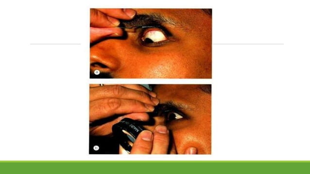 Fundus examination | PPTX | Eye and Vision Conditions | Diseases and ...