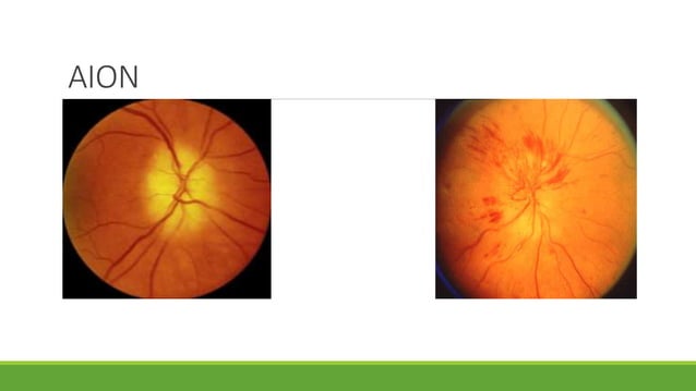 Fundus examination | PPTX | Eye and Vision Conditions | Diseases and ...