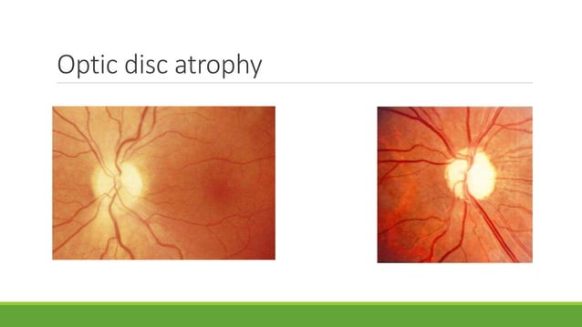 Fundus examination | PPTX | Eye and Vision Conditions | Diseases and ...