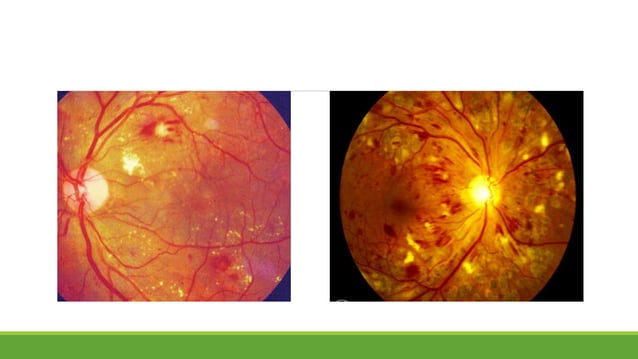 Fundus examination | PPTX | Eye and Vision Conditions | Diseases and ...