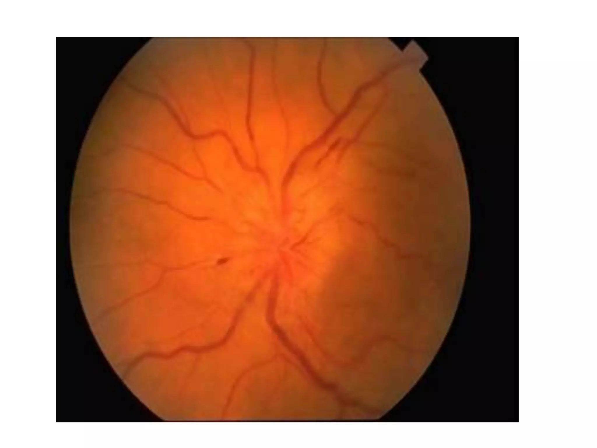 Fundus examination | PPTX
