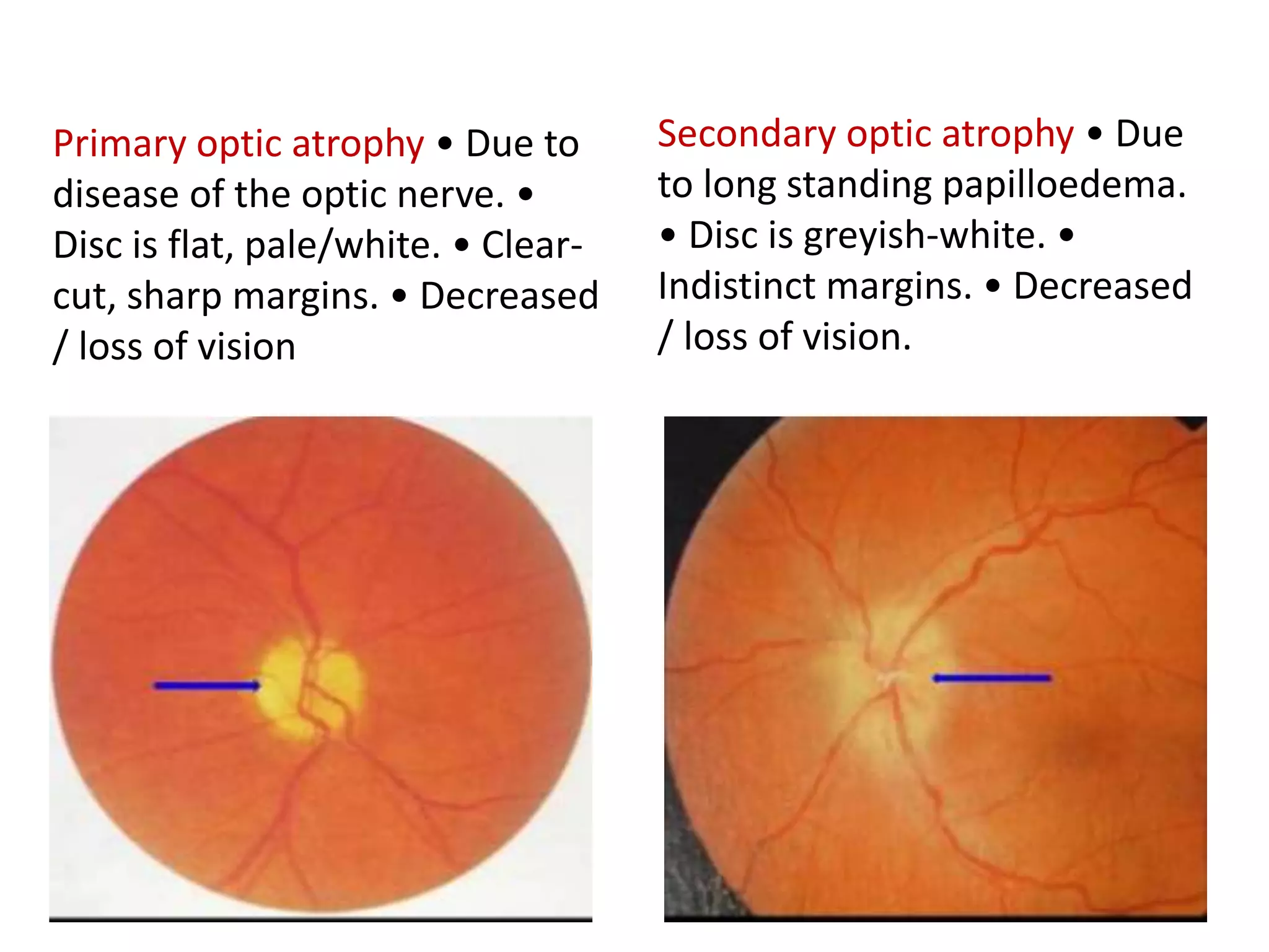 Fundus examination | PPTX